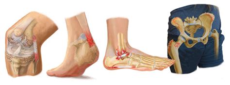 Enthesopathy Treatment