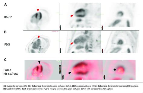 Myocardial Perfusion Fdg Correlation Download Scientific Diagram