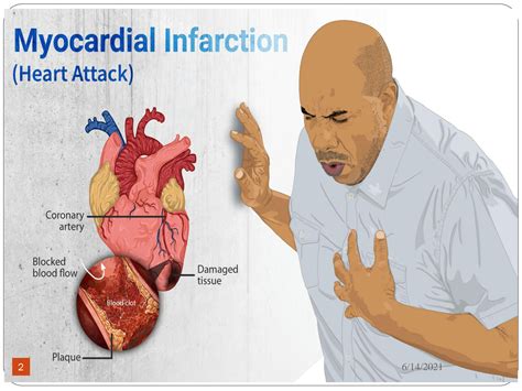 Solution Myocardial Infarction Anatomy Physiology Nursing Studypool