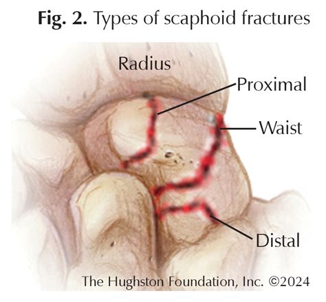 Scaphoid Fractures Hughston Clinic