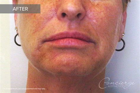 Before And After Juvederm Ultra And Voluma Yo Concierge Aesthetics