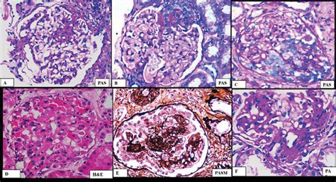 Fsgs Nos Pas Stain Fsgs Tip Variant Pas Stain Fsgs