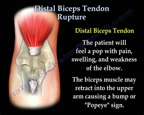 Distal Biceps Tendon Rupture Everything You Need To Know My Xxx Hot Girl