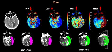 Ischemic Penumbra Stroke Manual