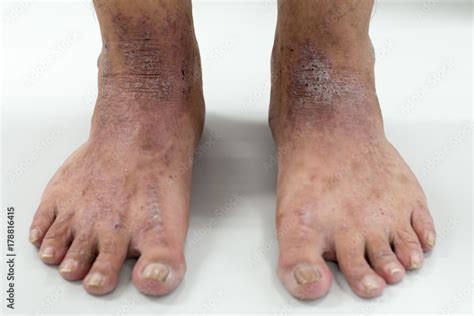 Atopic Dermatitis Ad Also Known As Atopic Eczema Is A Type Of