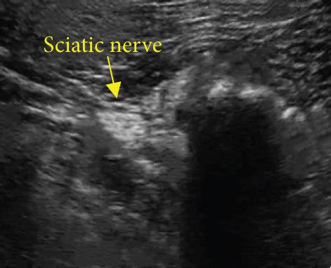 Ultrasound Images A Ultrasound Display Of The Sciatic Nerve B Download Scientific Diagram