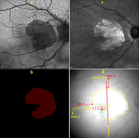 Retinal Sensitivity Loss Extends Past Lesion Borders In Ga