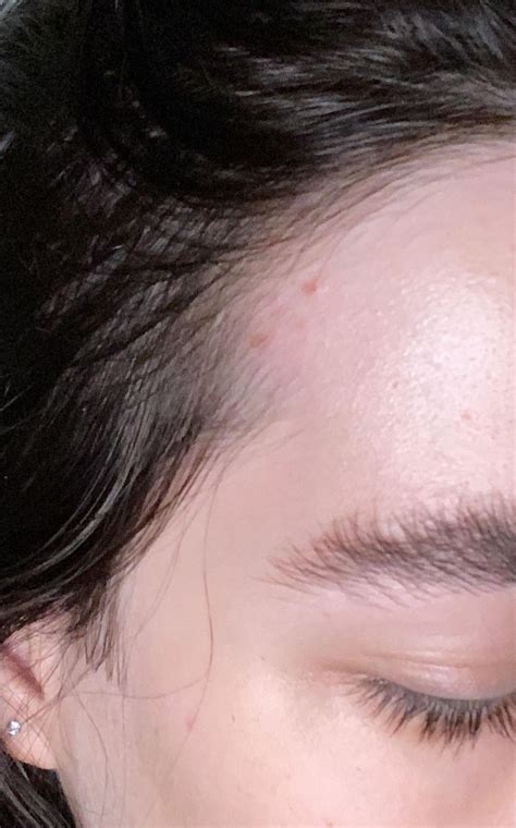 Why Do I Keep Getting Pimples Around My Hairline Racne