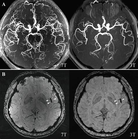 M2 Middle Cerebral Artery Dissection On 7t Mri Stroke And Vascular Neurology