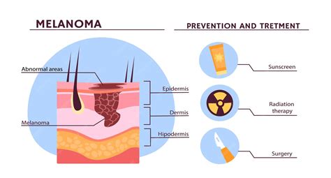 Premium Vector Melanoma Infografics Concept Educational Medical