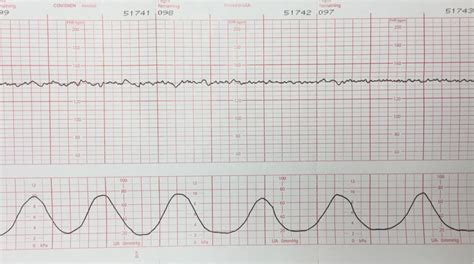 Contraction Patterns Military Obstetrics And Gynecology 3rd Edition