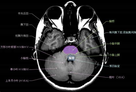 MRI入门丨头颅MR轴位解剖图彩色标注版 MedSci cn