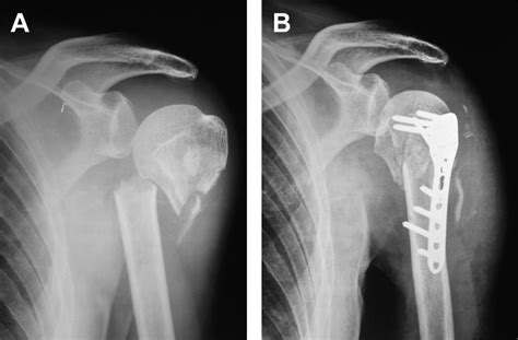Range Of Motion After Proximal Humerus Fracture At Dianna Wagner Blog