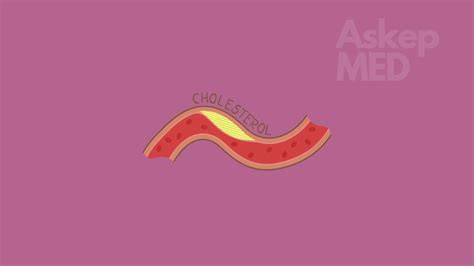 Aterosklerosis Penyebab Gejala Diagnosis Penanganan Askep Med