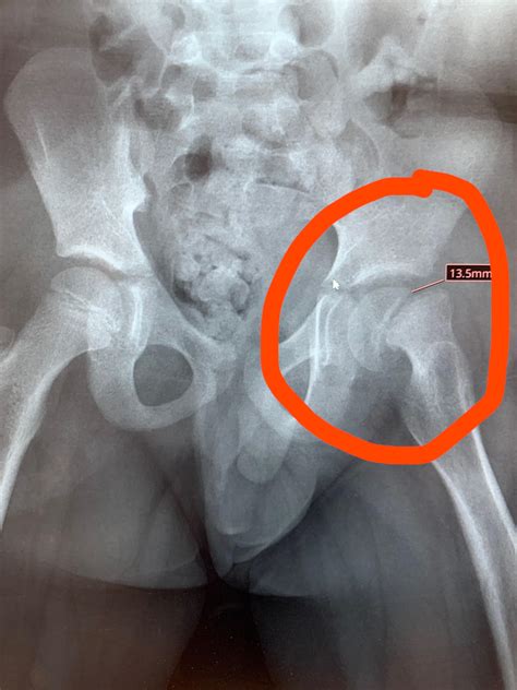 Scfe Rnursing Scfe Rnursing