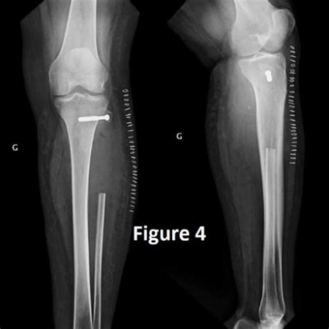 Frontal And Lateral Control Radiograph Showing The Fibular Head Fixed Download Scientific