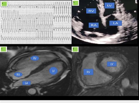 Ecg 2d Echo And Mri Findings Of Case 2 A Ecg Showed Frequent Download Scientific Diagram