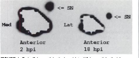 Figure 3 From Impact Of Lymphoscintigraphy On Sentinel Node