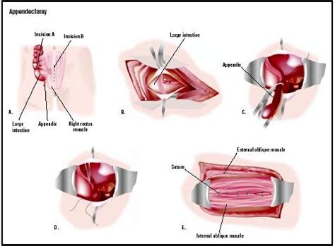 Laparoscopic Appendectomy