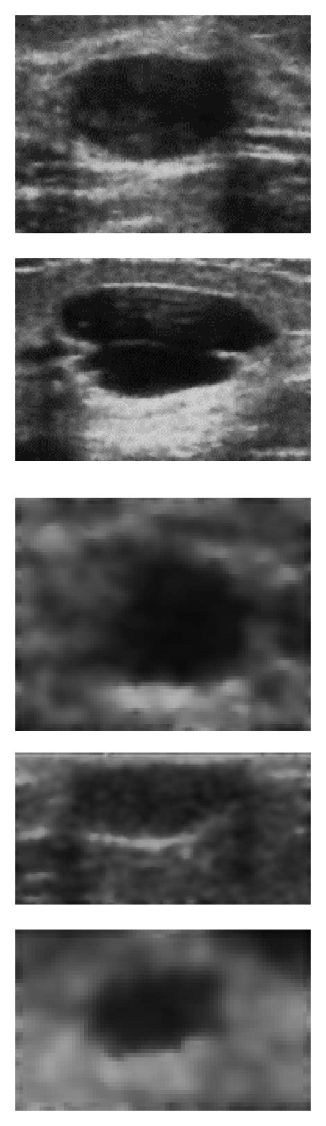 Preprocessing Application To Rois From Actual Breast Ultrasound Images