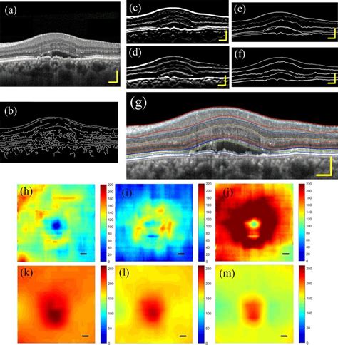 Automated Retinal Boundary Segmentation Of Optical Coherence Tomography Images Using An Improved