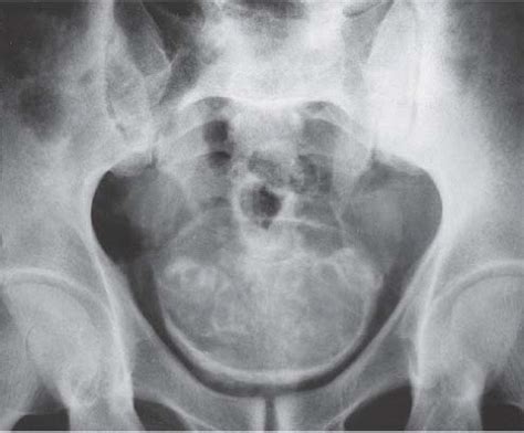 The Urinary Bladder Radiology Key