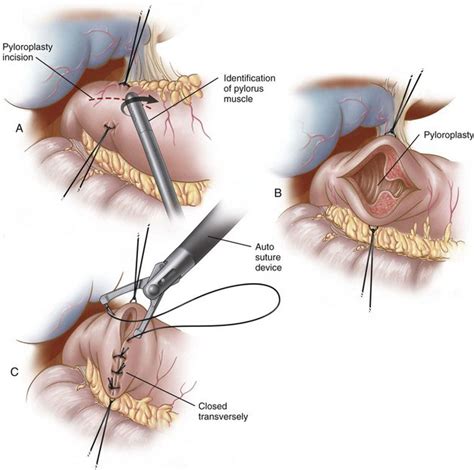 Minimally Invasive Ivor Lewis Esophagectomy Abdominal Key