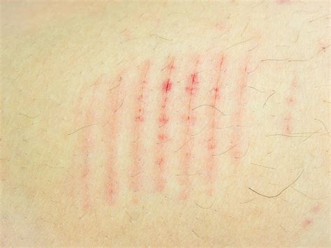 Close Up Scar Scratch On The Human Body Stock Photo At Vecteezy
