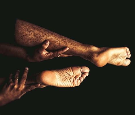 What Is Claudication Klarity Health Library