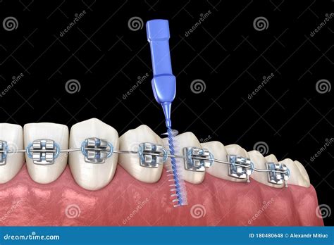 Cleaning Brace Tooth For Healthy Dental Dental Cartoon Vector
