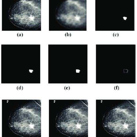 Pdf A Novel Approach For Breast Cancer Detection And Segmentation In A Mammogram