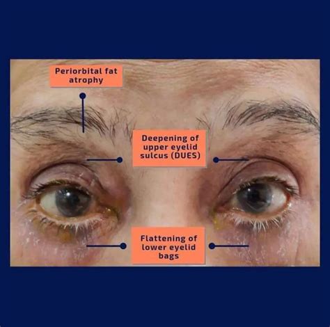 Prostaglandin Associated Periorbitopathypap An Eye Care Blog