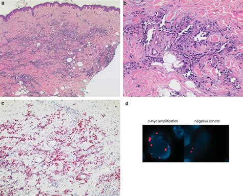 The Biopsy Of Case 42 Shows Features Of A Moderately Differentiated