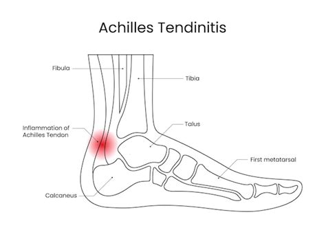 Tendinitis Vectors And Illustrations For Free Download