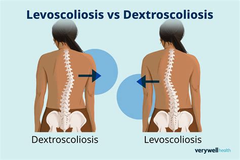 Levoscoliosis Vs Dextroscoliosis Difference And Diagnosis