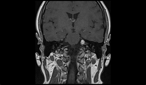 Acoustic Neuroma Mri Radiology Article On Acoustic Neuroma