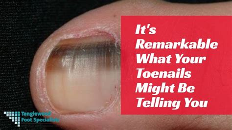 Toenail Fungus Or Melanoma