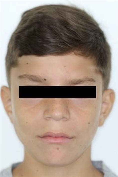 Frontal Extraoral Photograph Download Scientific Diagram