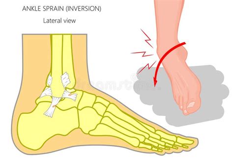 Ankle Sprain Inversion On White Bacground Stock Vector Illustration