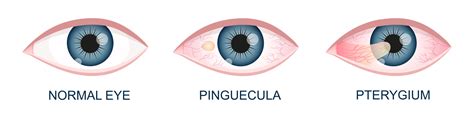 Eye Healthy With Pinguecula And Pterygium Growing Onto Cornea