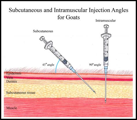 Comparison Of The Angles Of Intramuscular Ideal For Medical 50 Off