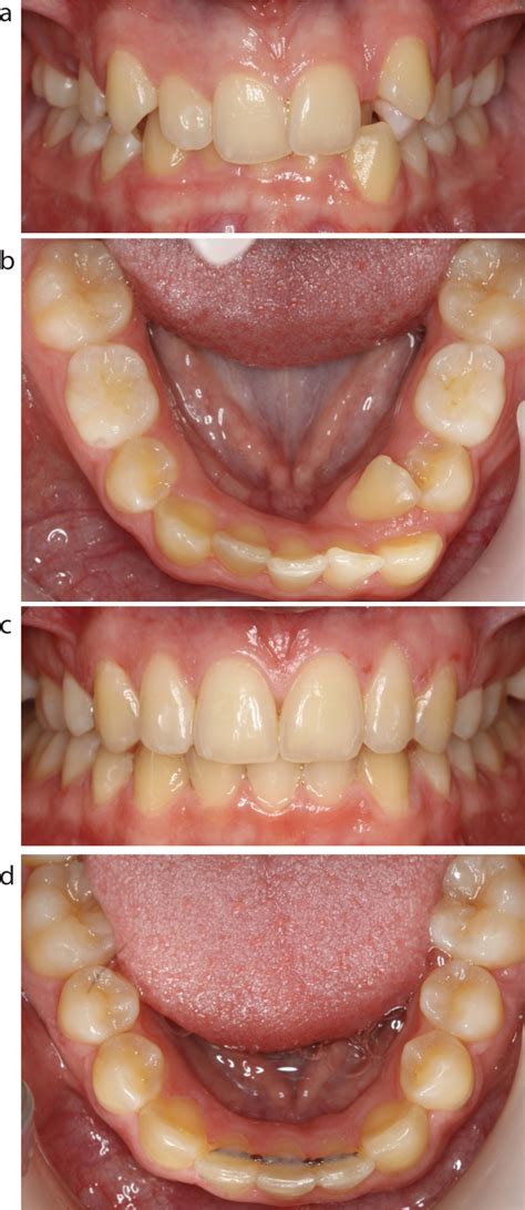 Orthodontic Update Management Of Lower Incisor Extraction Cases Part