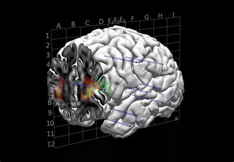 Integrating Mri Post Processing With Artificial Intelligence In Epilepsy