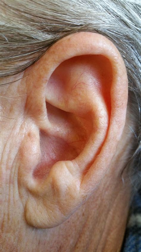 Difference Between Menieres Disease And Labyrinthitis Difference