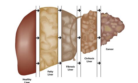 Non Invasive Assessment Of Hepatic Fibrosis And Portal Hypertension Epateamepateam