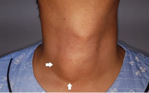 땡큐서울의원 지방종 은 지방세포로 이루어진 종양으로 목 뒤 목 앞 등 뒤 허벅지 종아리 팔