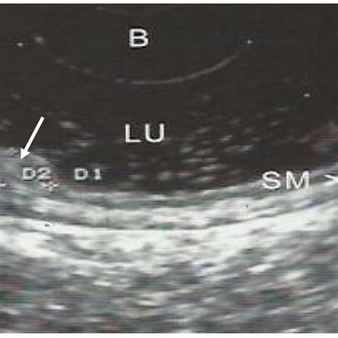 Eus Of Early Gastric Cancer At The Lesser Curvature Of The Gastric Eus Of Early Gastric Cancer At The Lesser Curvature Of The Gastric