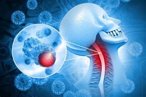 Thyroid Gland Cancer Showing Thyroid Gland With Tumor Stock Illustration Illustration Of