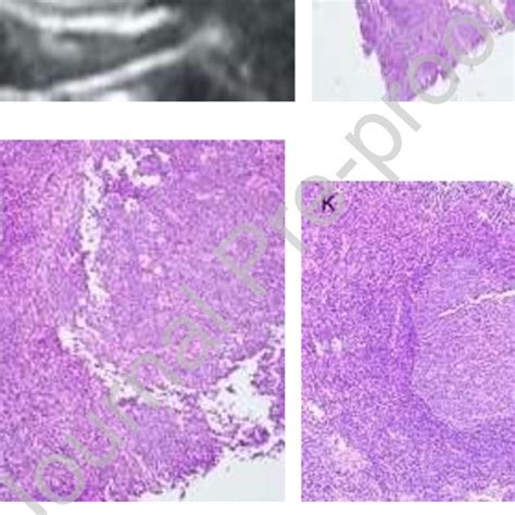42 Year Old Female With Unilateral Left Axillary Adenopathy Noted 5