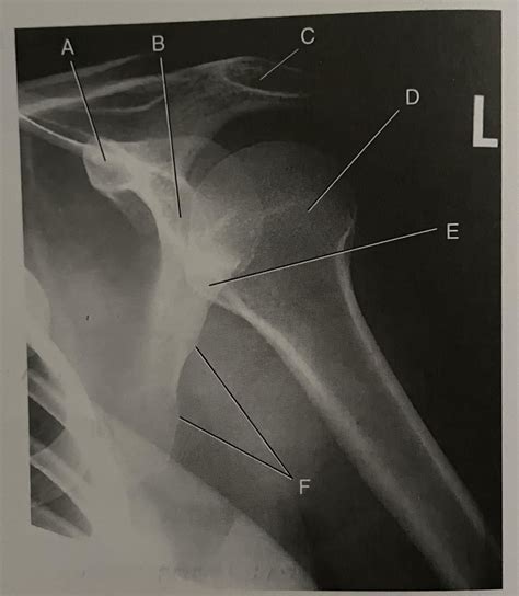 Lateral Proximal Humerus Diagram Quizlet